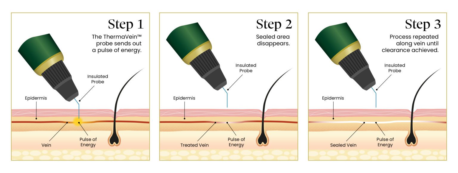 Thermocoagulation for Thread Veins | VeinCentre
